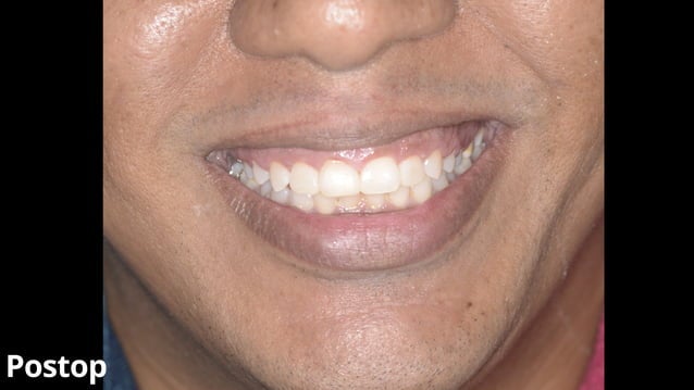 Direct Veneers done using the Bioclear technique | PPTX