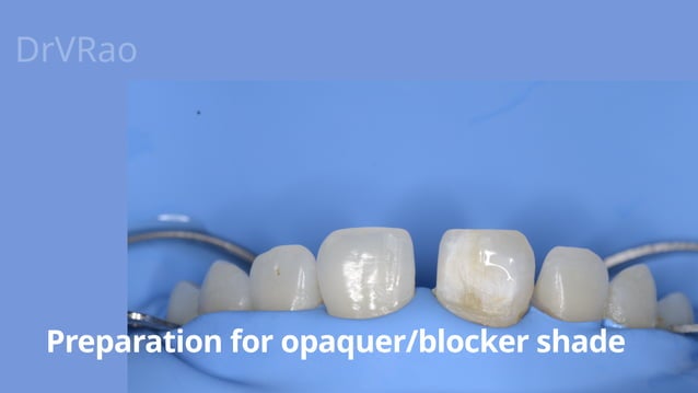 Direct Veneers done using the Bioclear technique | PPTX