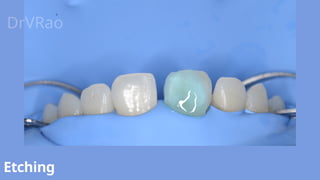 Direct Veneers done using the Bioclear technique | PPTX