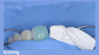 Direct Veneers done using the Bioclear technique | PPTX