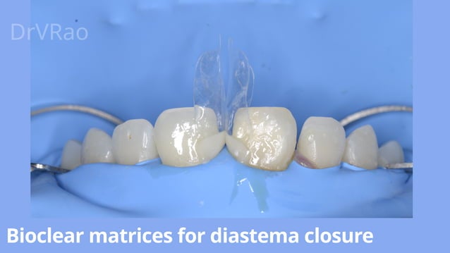 Direct Veneers done using the Bioclear technique | PPTX