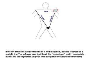Disabled lead cables | PPT