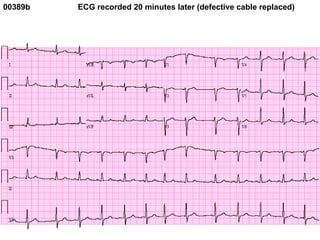 Disabled lead cables | PPT