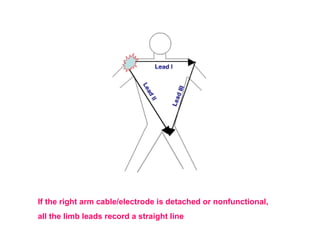Disabled lead cables | PPT