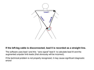 Disabled lead cables | PPT