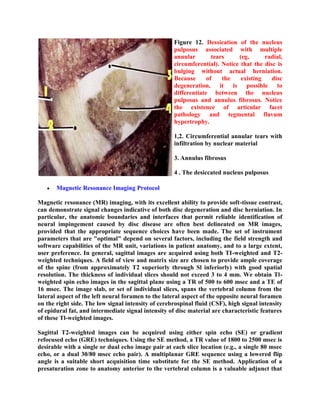 Radiological pathology of Disc degeneration | PDF