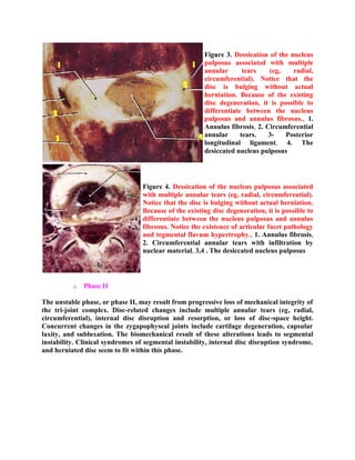 Radiological pathology of Disc degeneration | PDF