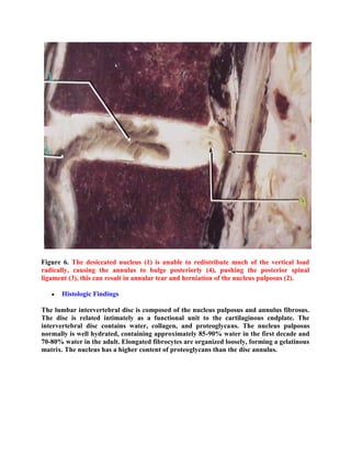 Radiological pathology of Disc degeneration | PDF