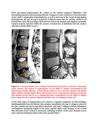 Radiological pathology of Disc degeneration | PDF