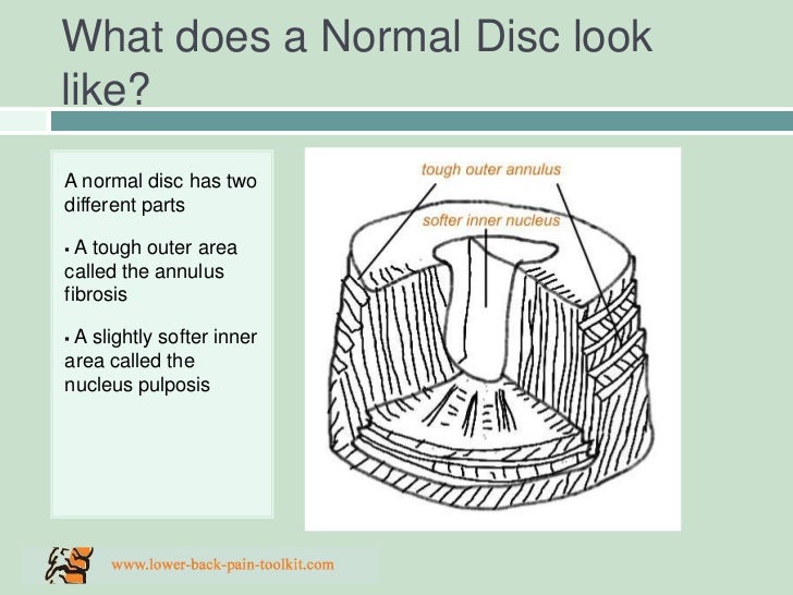 A Simple Guide to Disc Bulges and Prolapses