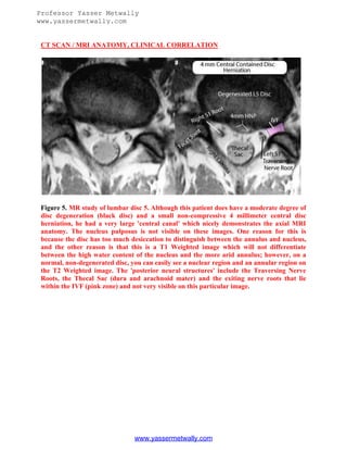 Pathology/pathogenesis of lumbar disc degeneration | PDF