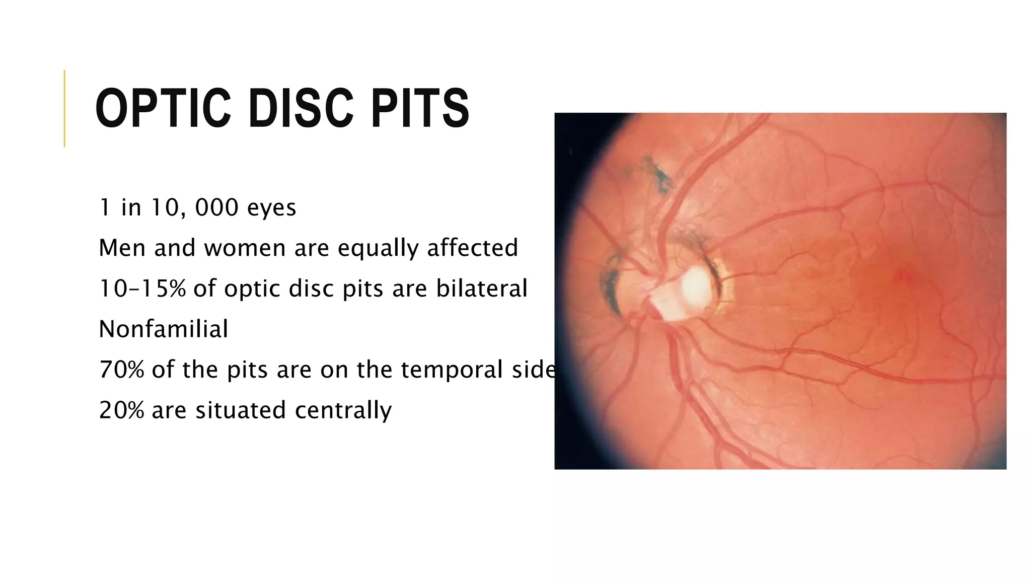 Disc anomalies, pits and treatment of associated | PPTX