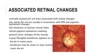 Disc anomalies, pits and treatment of associated | PPTX