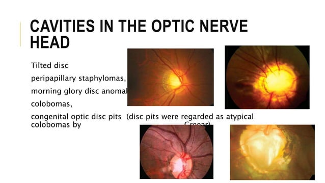Disc anomalies, pits and treatment of associated | PPT