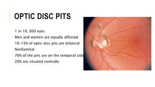 Disc anomalies, pits and treatment of associated | PPTX