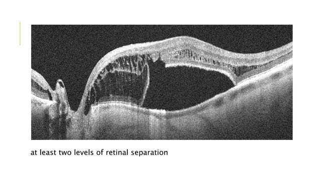 Disc anomalies, pits and treatment of associated | PPT