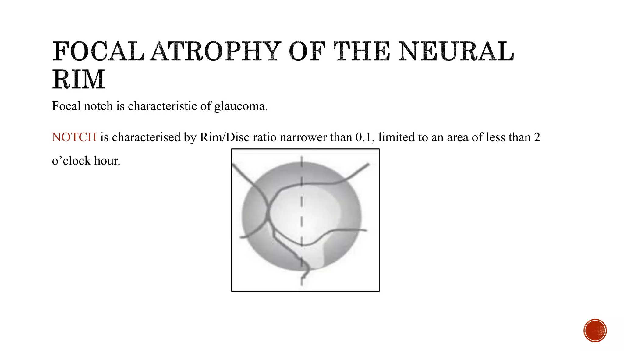 Disc Damage Likelihod Scale (DDLS) | PPTX