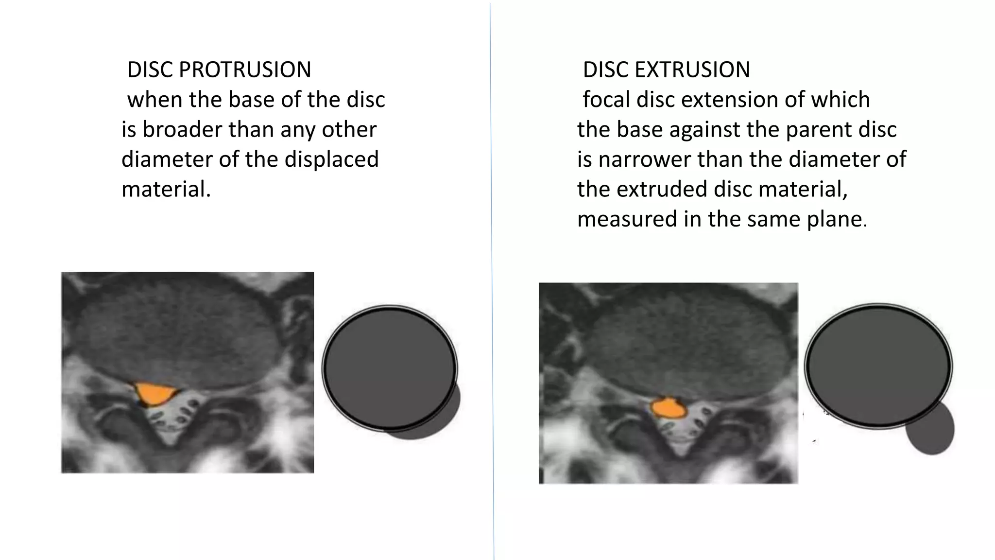 degenerative disease of sine | PPTX