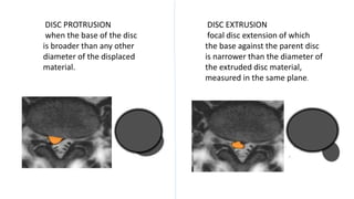degenerative disease of sine | PPTX