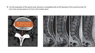 degenerative disease of sine | PPTX
