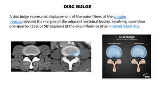 degenerative disease of sine | PPTX
