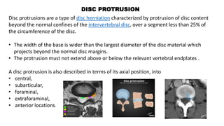 degenerative disease of sine | PPTX