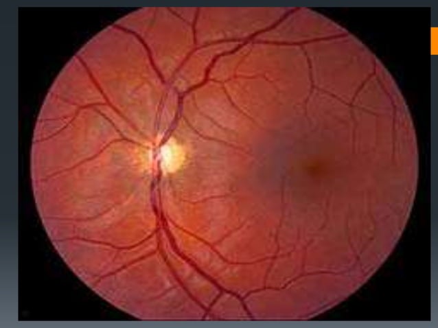 Disc edema | PPTX | Brain and Nervous System Disorders | Diseases and ...