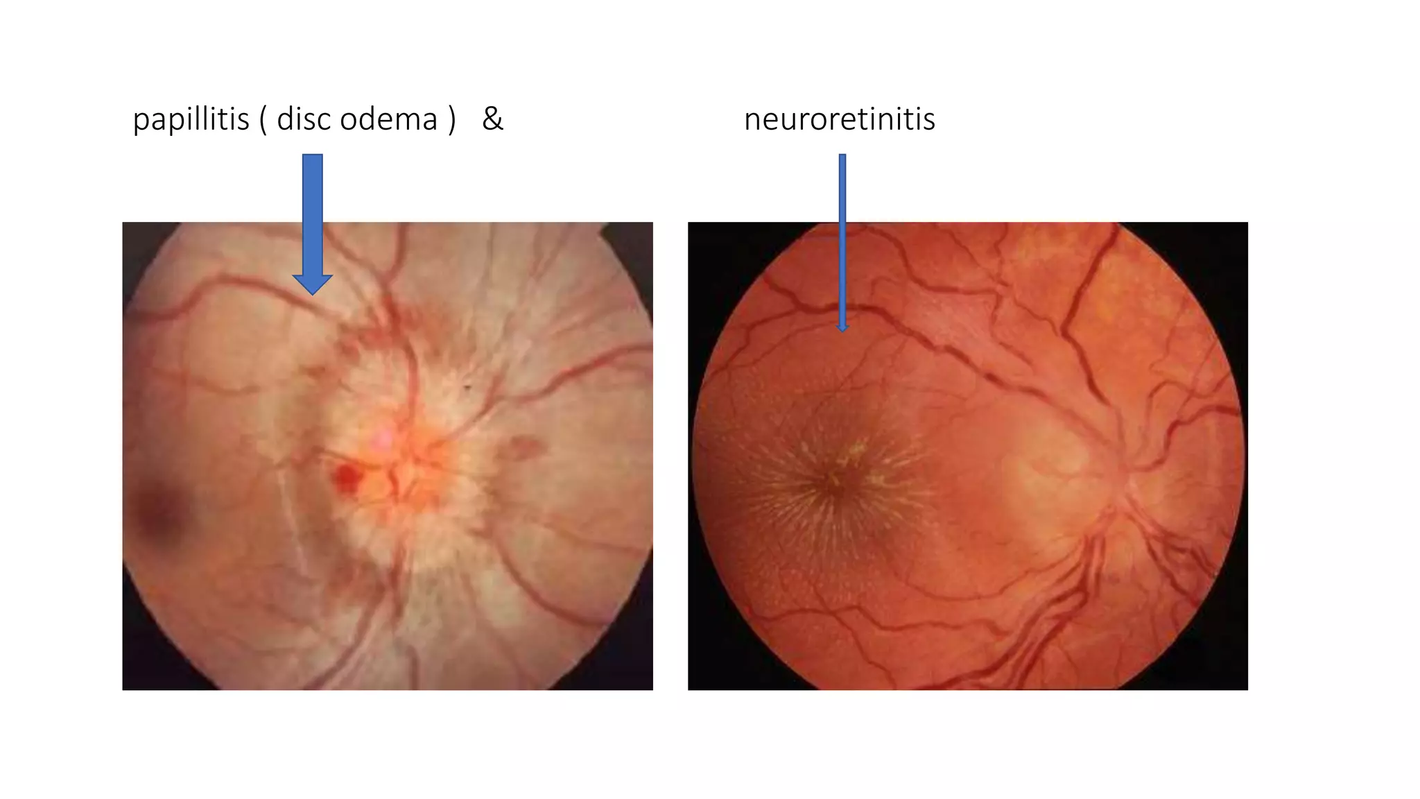 Disc edema ,papilloedema & optic neuritis | PPTX