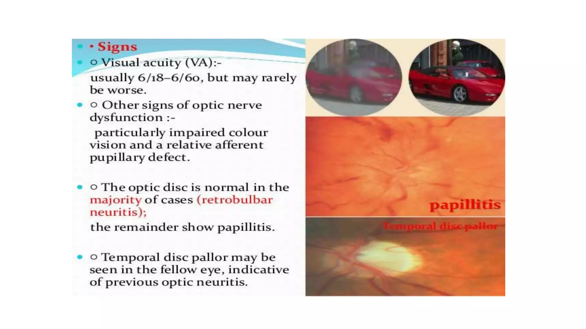 Disc edema ,papilloedema & optic neuritis | PPTX