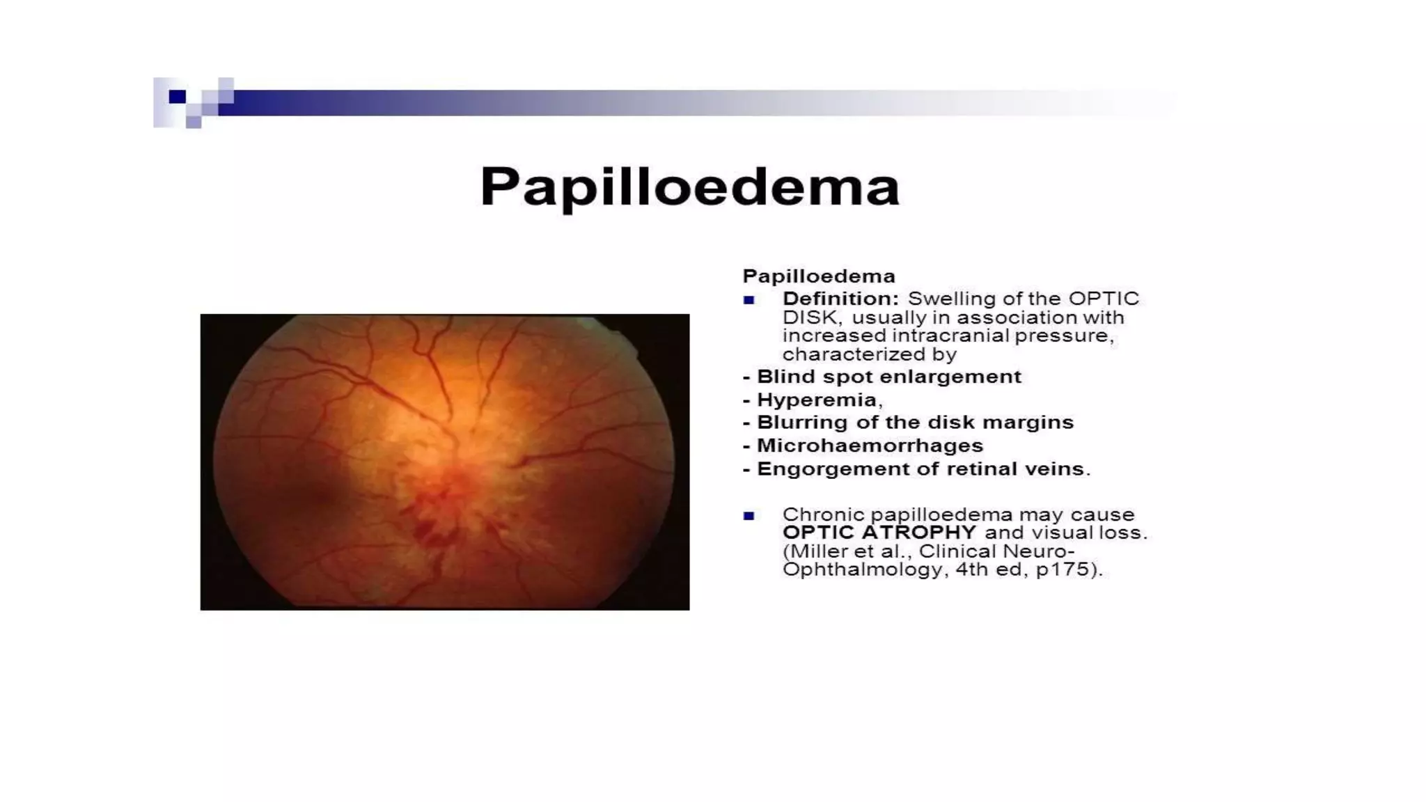Disc edema ,papilloedema & optic neuritis | PPTX