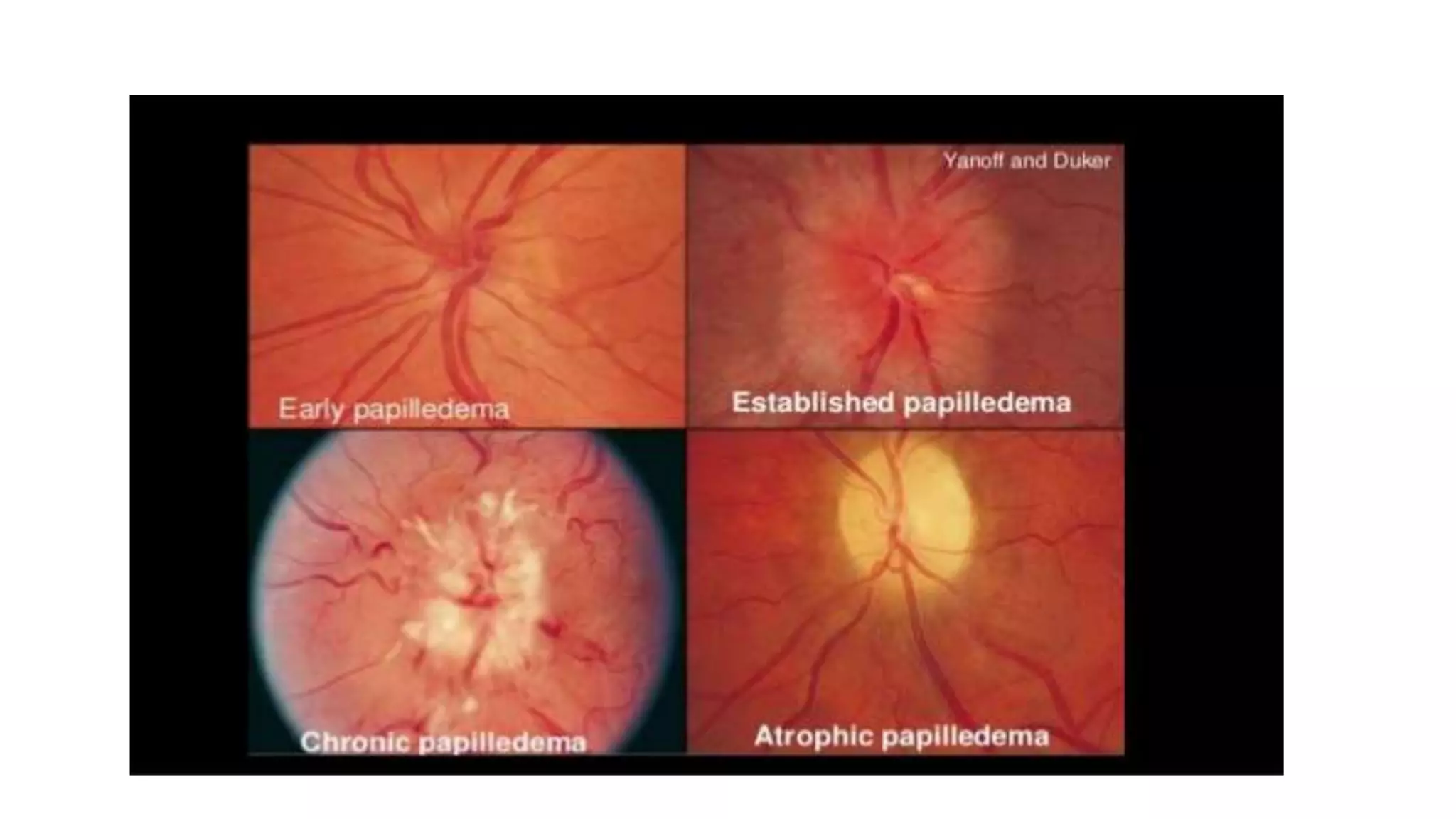 Disc edema ,papilloedema & optic neuritis | PPTX