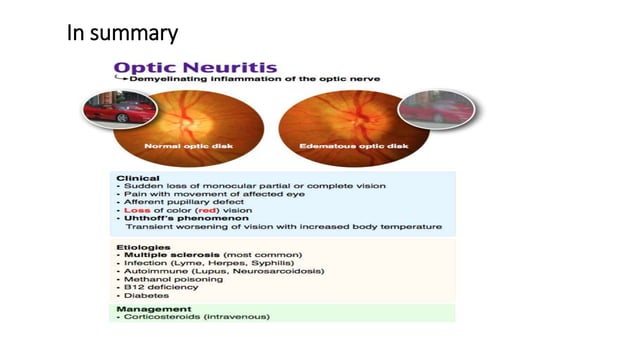 Disc edema ,papilloedema & optic neuritis | PPTX