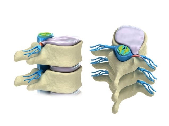 Disc herniation and its management .pptx | Free Download