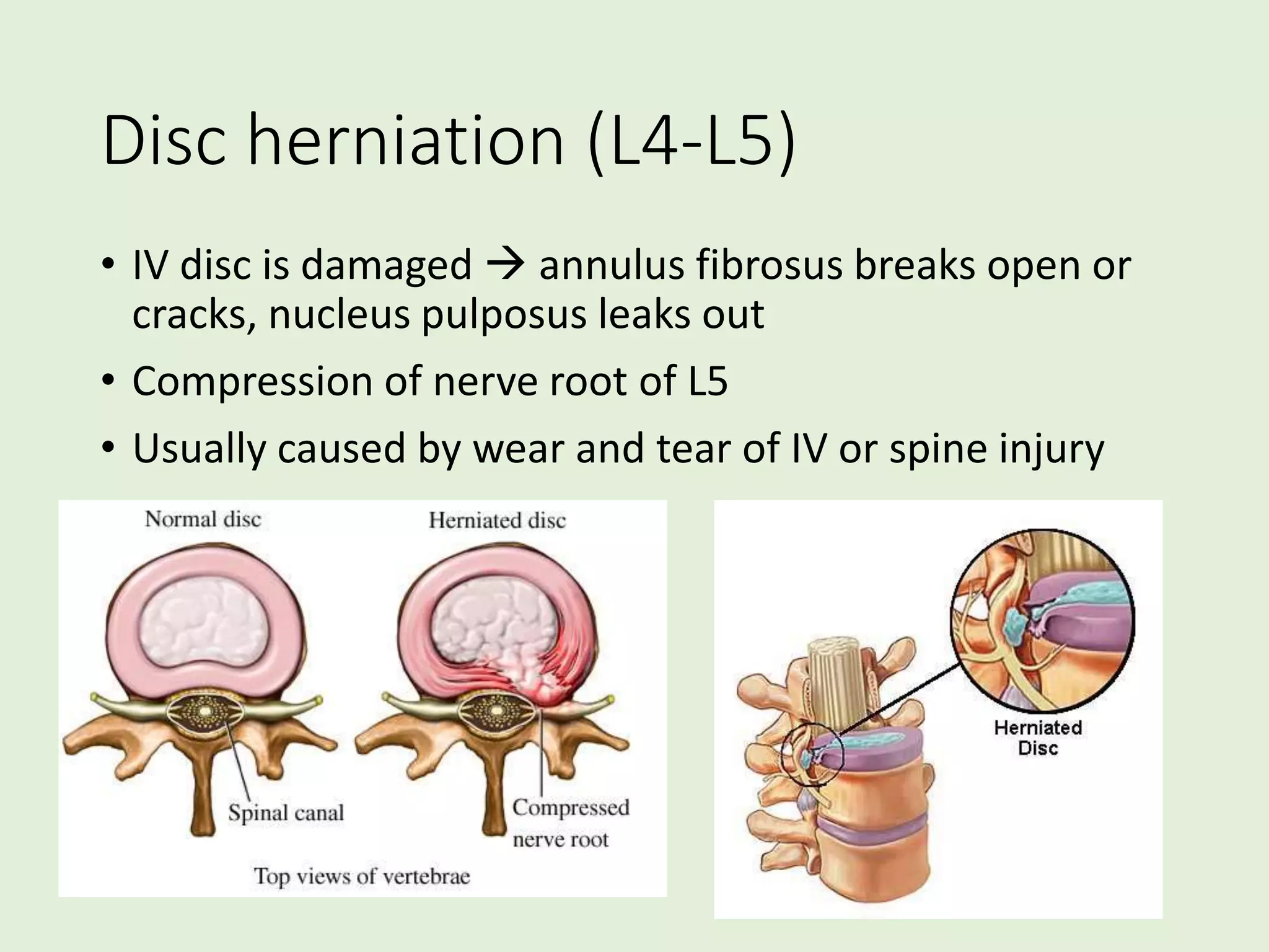 Disc herniation | PPTX