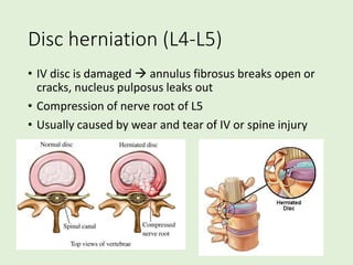 Disc herniation | PPT