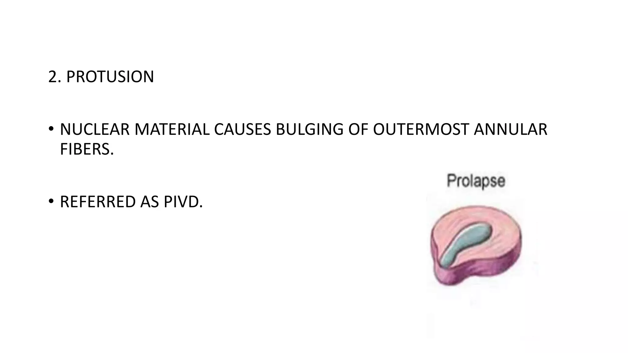 Disc herniation | PPTX