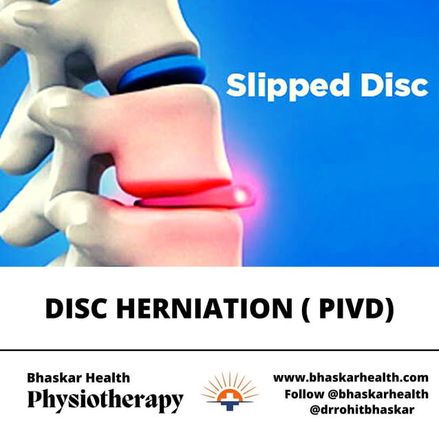 PIVD (Slipped or Herniated Disc): Physiotherapy Treatment | PDF