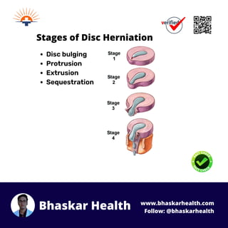 PIVD (Slipped or Herniated Disc): Physiotherapy Treatment | PDF