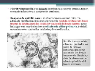Discinesia ciliar primaria | PPT