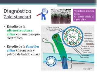 Discinesia ciliar primaria | PPT