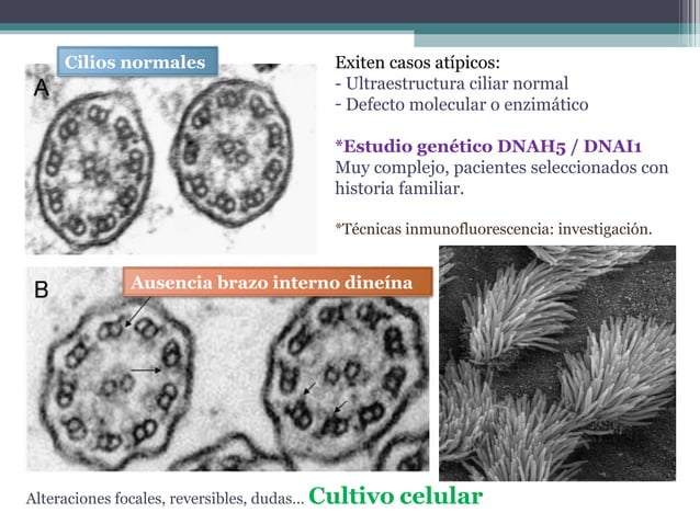 Discinesia ciliar primaria | PPT