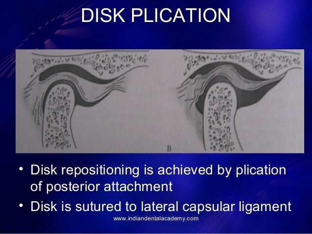 Disc interfernece disorder/endodontic courses
