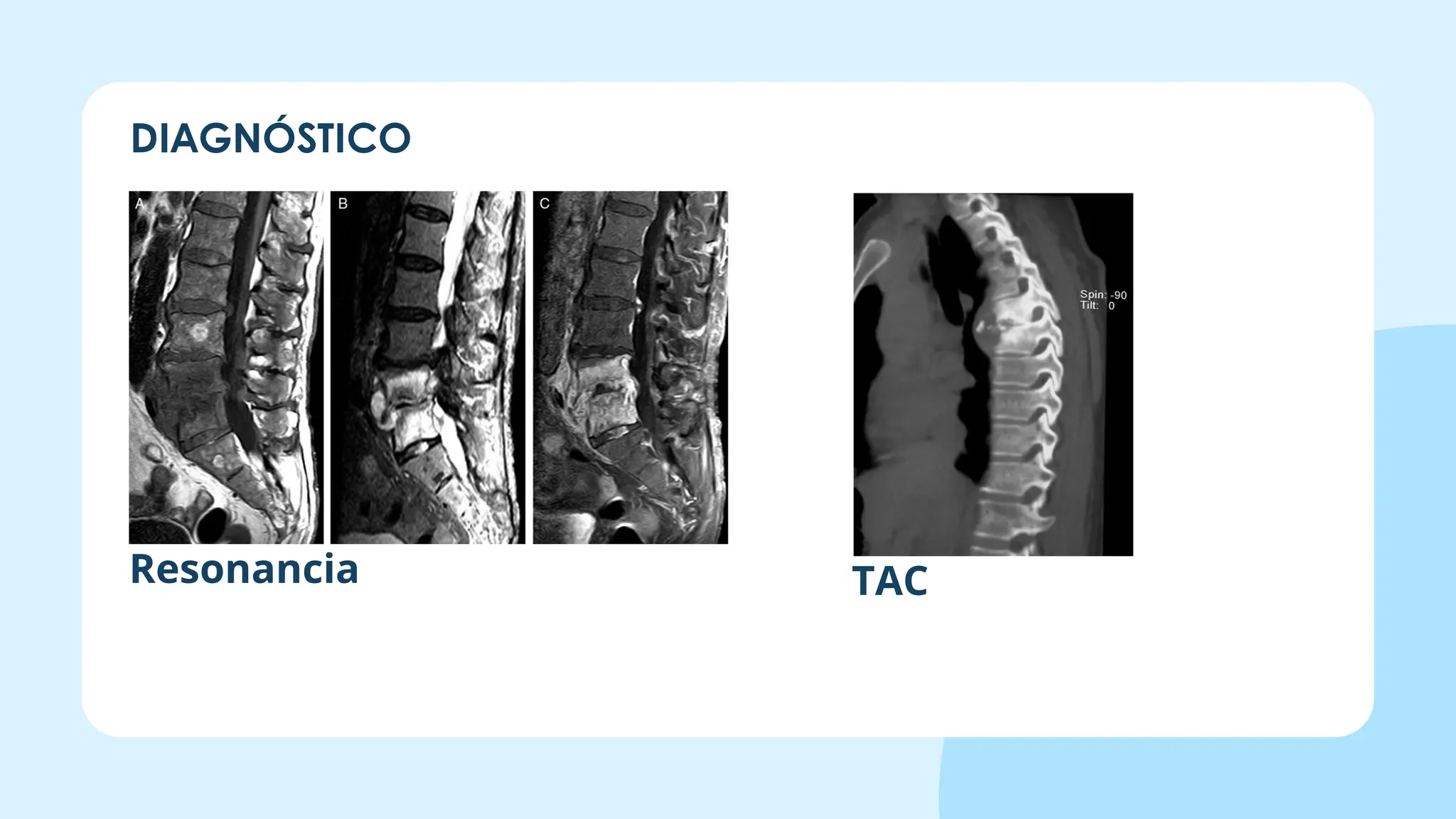 Enfermedad infecciosa del cordon medular o columna vertebral, Discitis | PPT