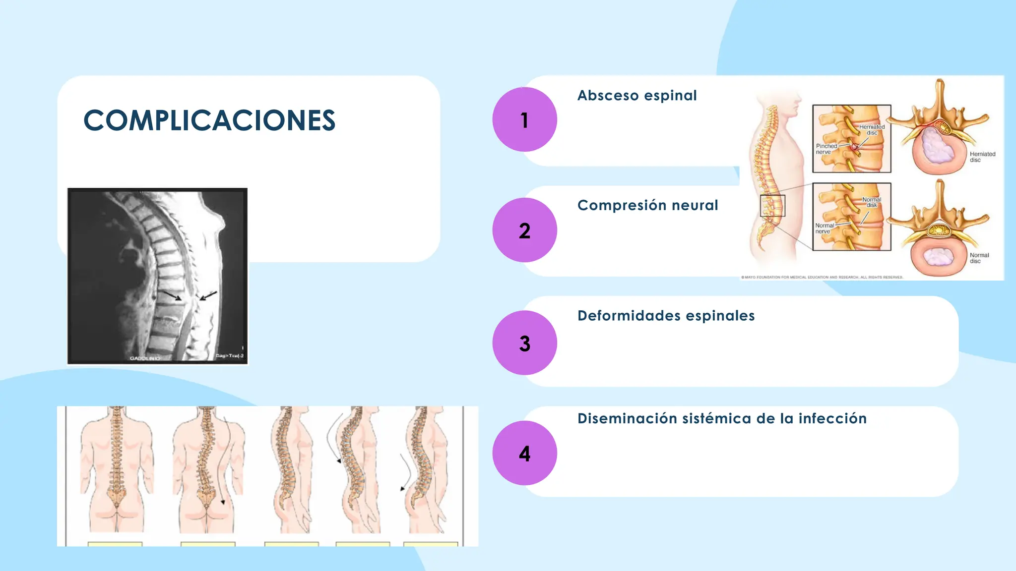 Enfermedad infecciosa del cordon medular o columna vertebral, Discitis | PPT