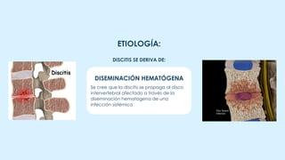 Enfermedad infecciosa del cordon medular o columna vertebral, Discitis | PDF