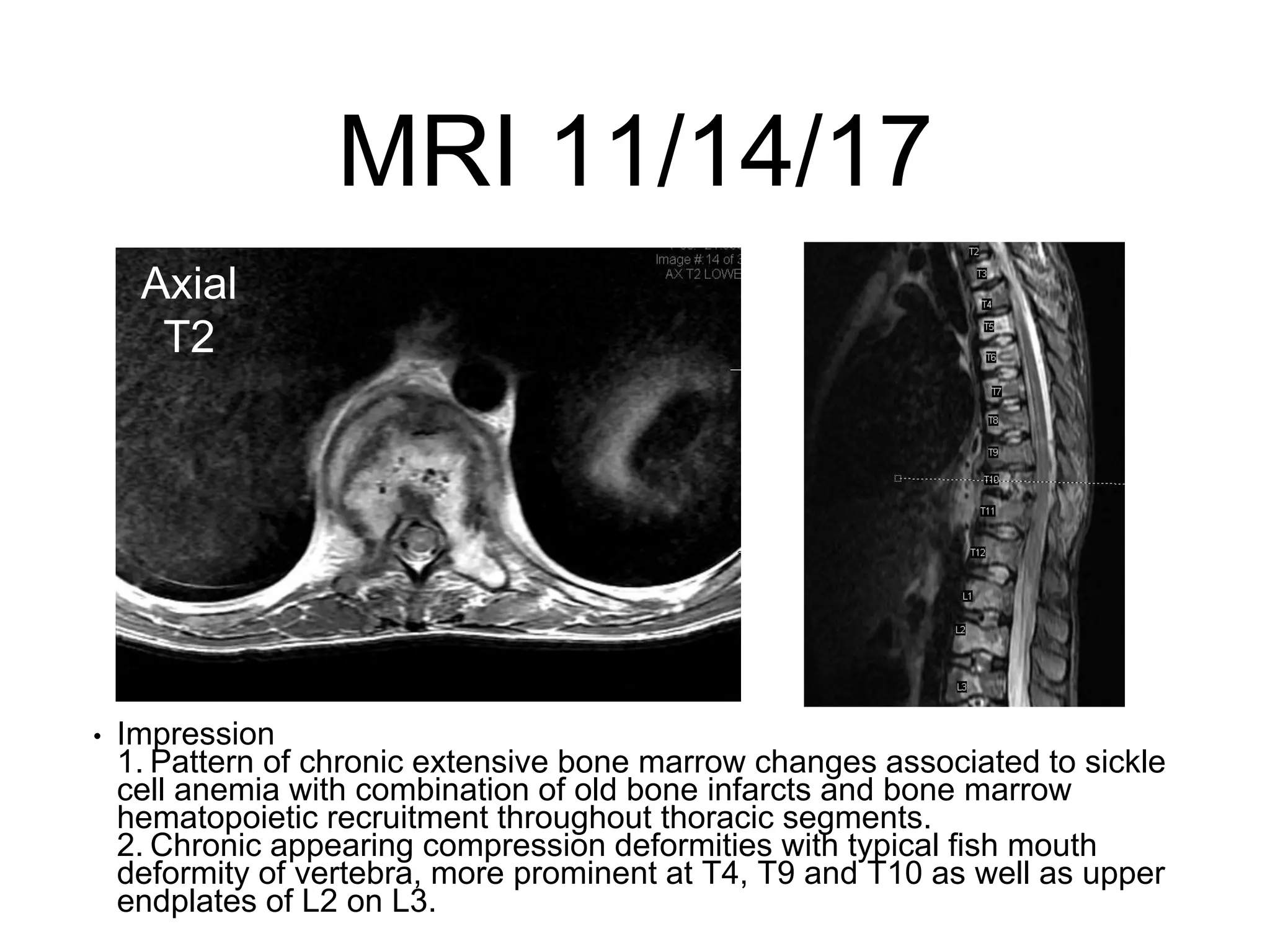 Discitis and osteomyelitis in Sickle cell disease | PPTX | Bone and Joint Conditions | Diseases ...