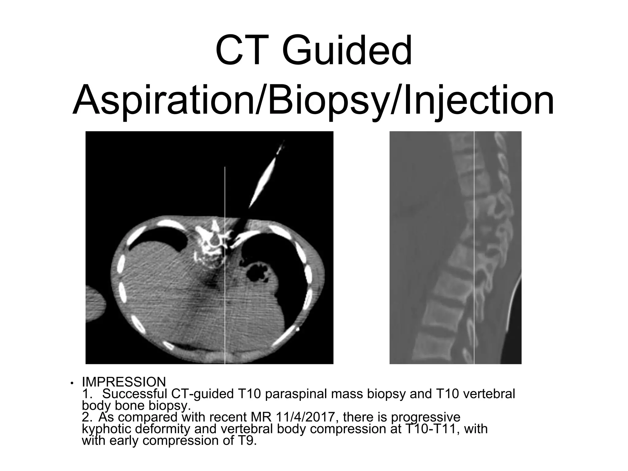 Discitis and osteomyelitis in Sickle cell disease | PPTX