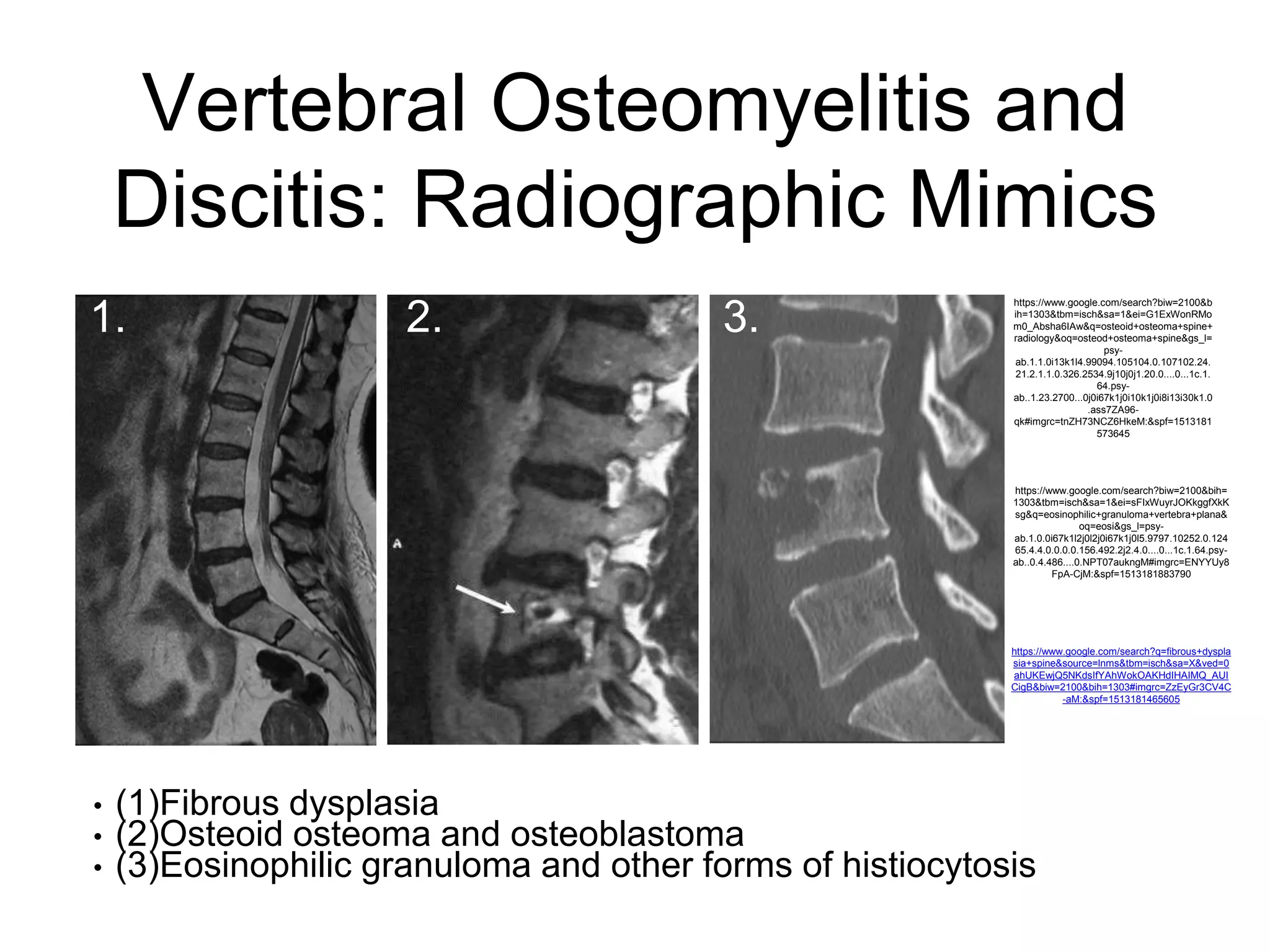 Discitis and osteomyelitis in Sickle cell disease | PPTX | Bone and Joint Conditions | Diseases ...