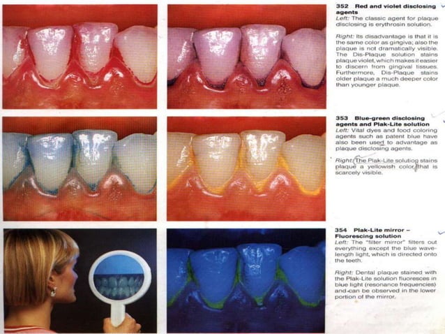 DISCLOSING AGENTS in dentistry ptx | PPTX | Oral care | Personal Care