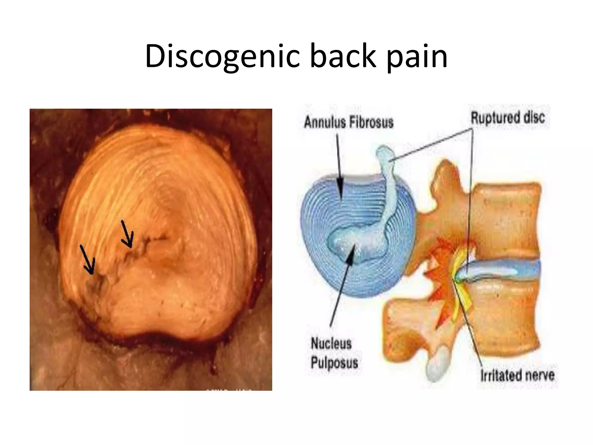 Discogenic back pain:Non-operative treatment by Dr Ashok Jadon,MD FIPP ...